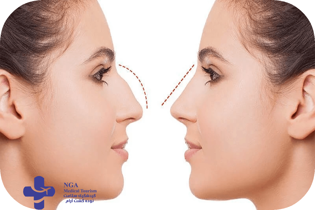 What is the best nose shape? All About Nose Shapes | Medical Tour in Iran